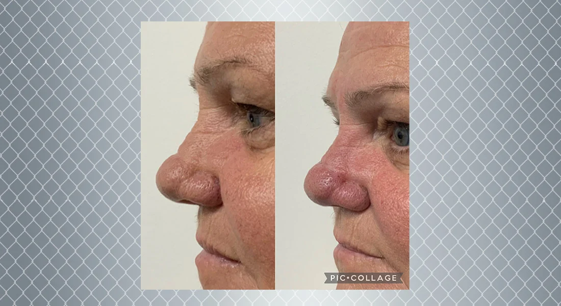 Nose Remodelling Gold Coast, Non Surgical Rhinoplasty, Nose Job